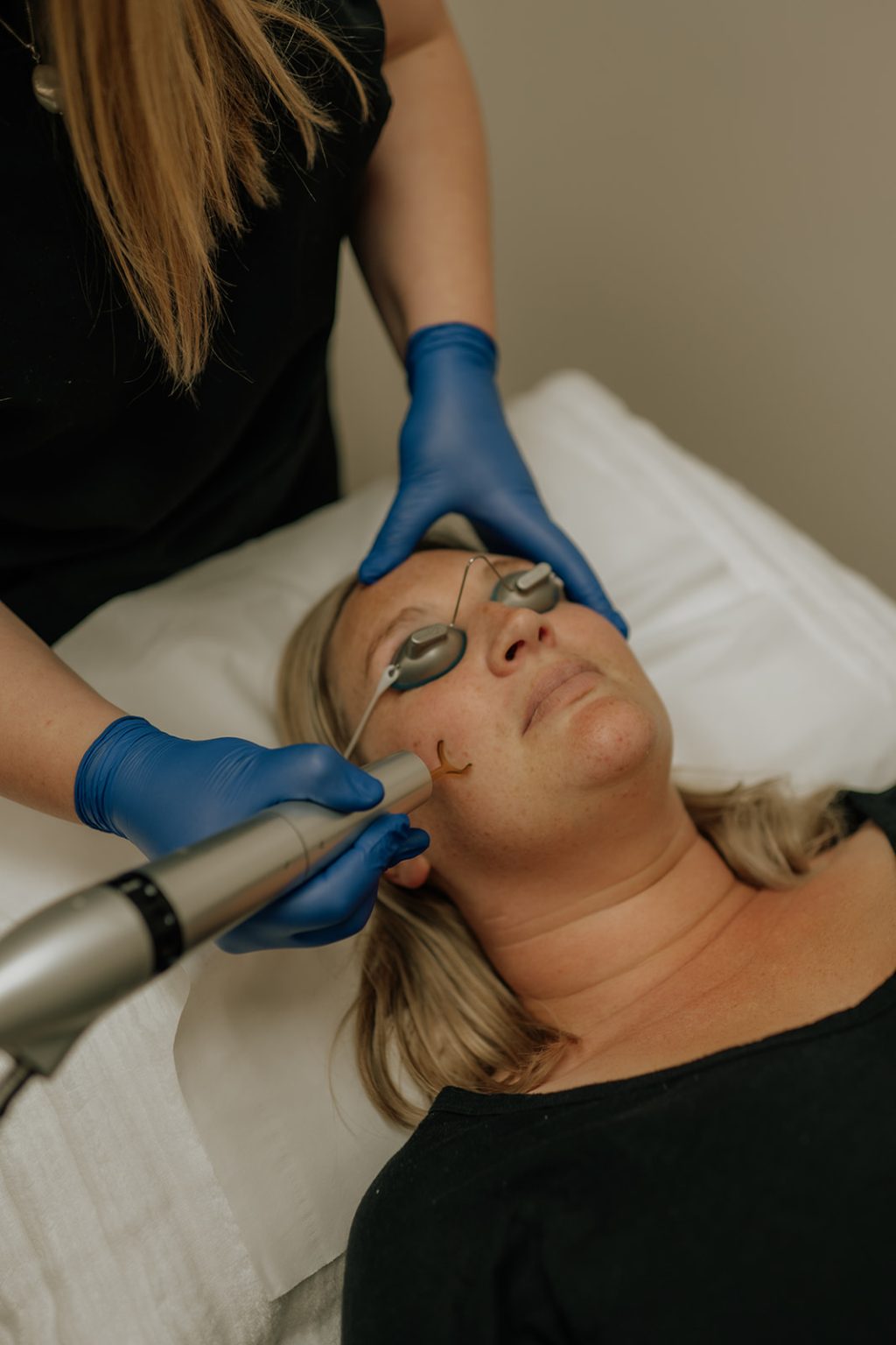 PicoWay Laser Hobart | O'Skin Skin Rejuvenation